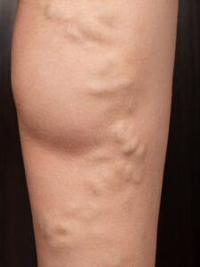 Tipos de Tratamentos Para Varizes - Dra. Lara Poltronieri ...