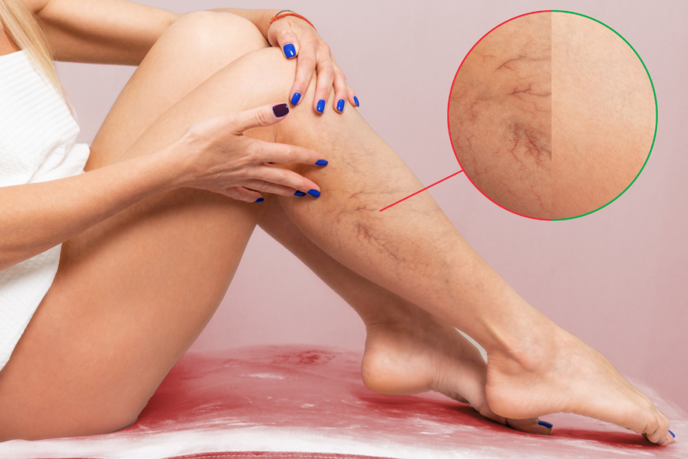 Tudo sobre varizes na perna - Dra Lara Poltronieri