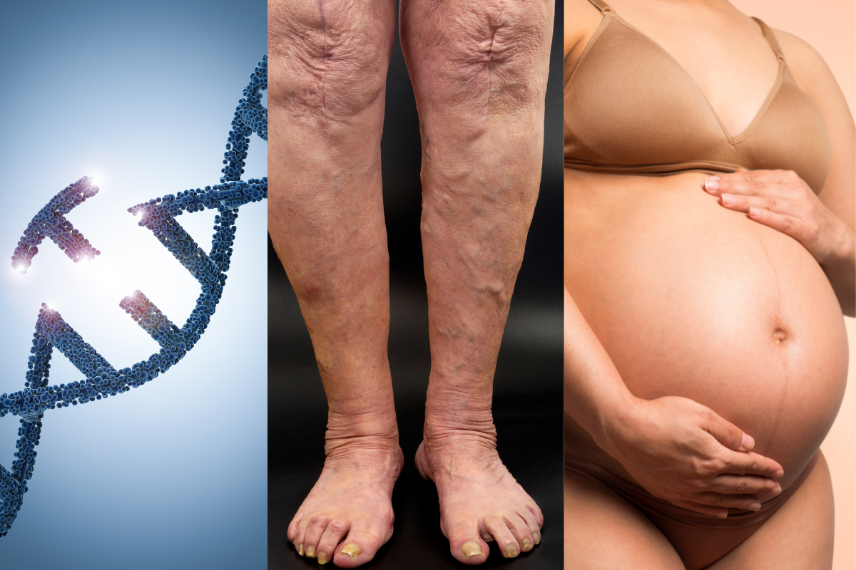 Tudo sobre varizes na perna - Dra Lara Poltronieri