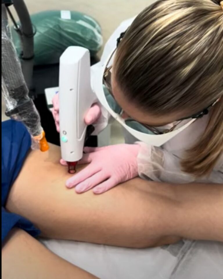 Tudo Sobre O que é Cirurgia de Varizes a Laser 2025 - Dra. Lara ...