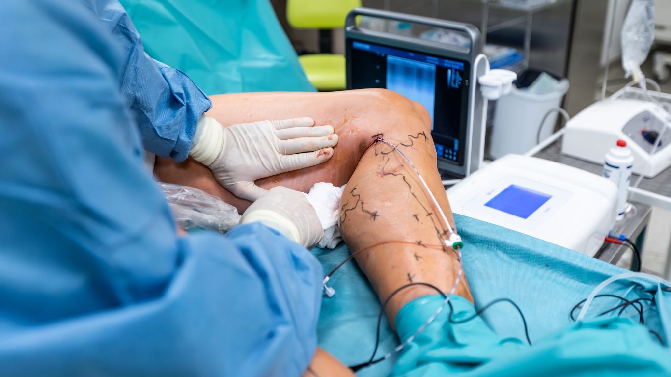 Tipos de Cirurgia de Varizes. Principais Opções – Dra. Lara Poltronieri